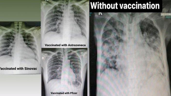 Penjelasan Dokter soal Foto Viral Hasil Rontgen Paru-Paru Pasien Covid ...