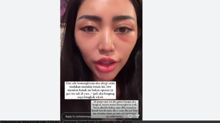 Muka Berubah, Rachel Vennya Akui Sedot Lemak Pipi, Ini Penampakannya - Tribunjateng.com