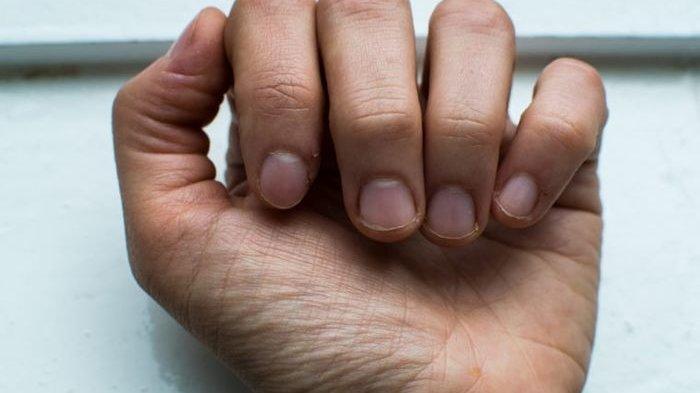 Apa Itu Frostbite? Ini Pertolongan Pertama Jika Mengalami Frostbite ...