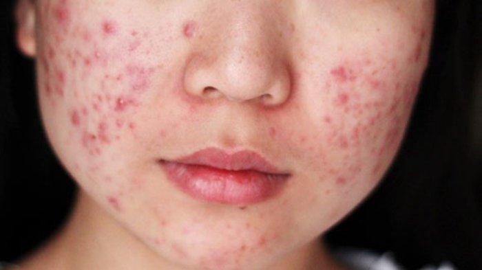 Arti Kata Breakout Dalam Kamus Bahasa Inggris, Simak Maknanya di Bidang Kesehatan Kulit ...