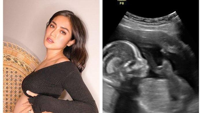 Kekhawatiran Jedar soal Kondisi Leher Janinnya, Istri Vincent Verhaag ...