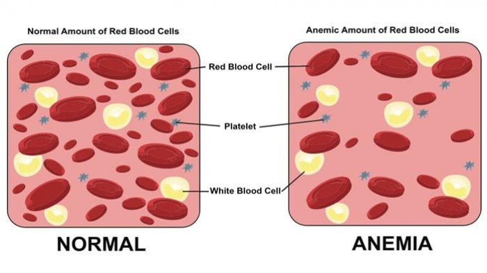 INFO SEHAT HARI INI - 6 Tanda Anemia yang Sering Diabaikan dan Cara ...
