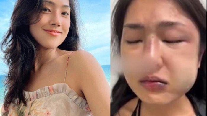 Artis Cantik Pergoki Pacar Selingkuh Malah Dipukuli di Hari Ulang Tahun, Wajah Lebam: Saya Sedih ...