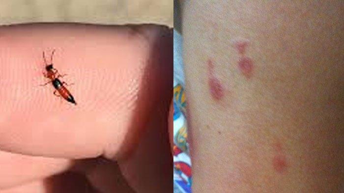 Pencegahan Racun Semut Charlie atau Tomcat Agar Tak Melepuh Bila ...