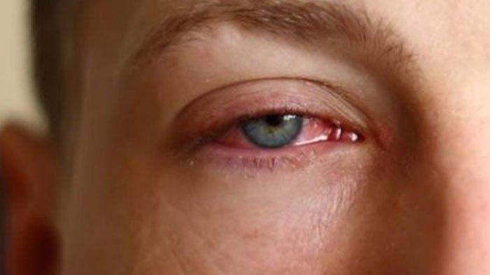 Penyakit Mata Merah Serang Warga Sampang, Dinkes Beberkan Pemicu dan ...