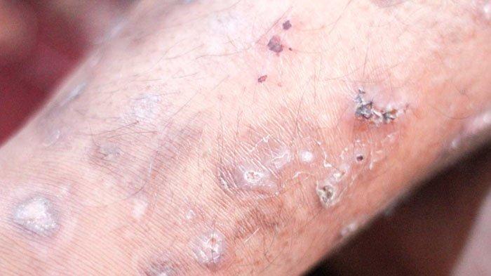 Mengenal Berbagai Obat Scabies dan Cara Kerjanya, Ketahui Juga Beberapa ...