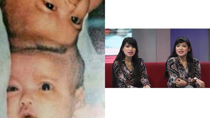 34 Tahun Sejak Operasi, Nasib Kembar Siam Yuliana Yuliani Kini Makin Sukses Jadi Dokter dan ...