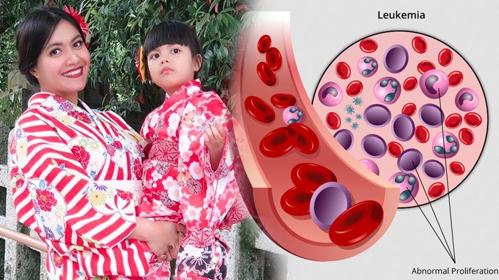 5 Hal Tentang Leukemia pada Anak yang Perlu Diketahui, Penyakit yang ...