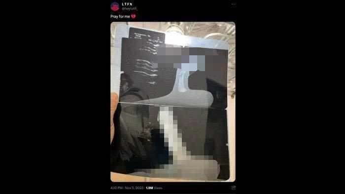 Viral Medsos Foto Rontgen Mr P Bisa Patah, Ternyata Begini Penjelasan ...