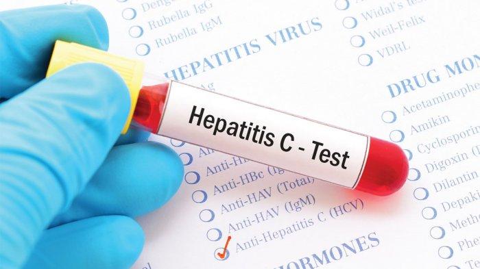 Mengenal Hepatitis C atau Penyakit Kuning : Penyebab, Gejala, dan ...