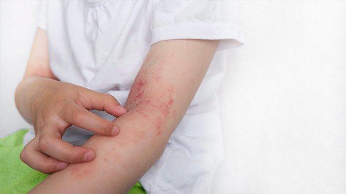 5 Cara Meredakan Alergi Susu Pada Anak - Tribunjogja.com