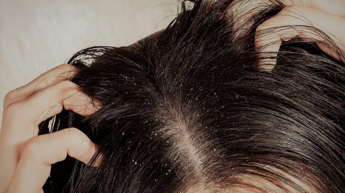 Ini Cara Menggunakan Bahan Alami untuk Mengatasi Masalah Ketombe ...