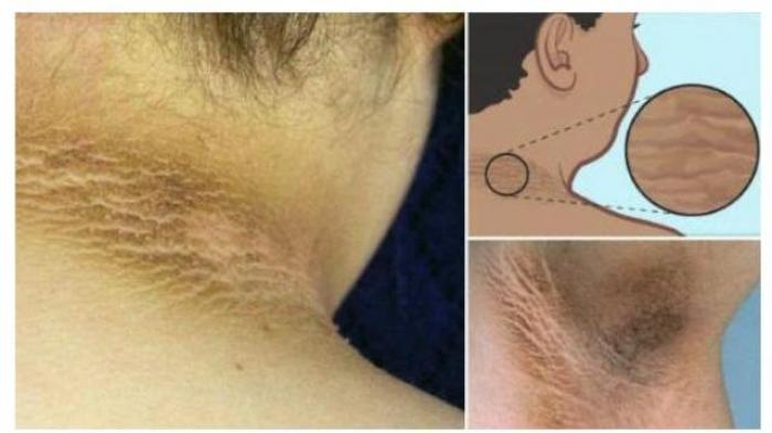 Mengenal Gejala Diabetes : Muncul Warna Hitam di Lipatan Kulit Leher ...
