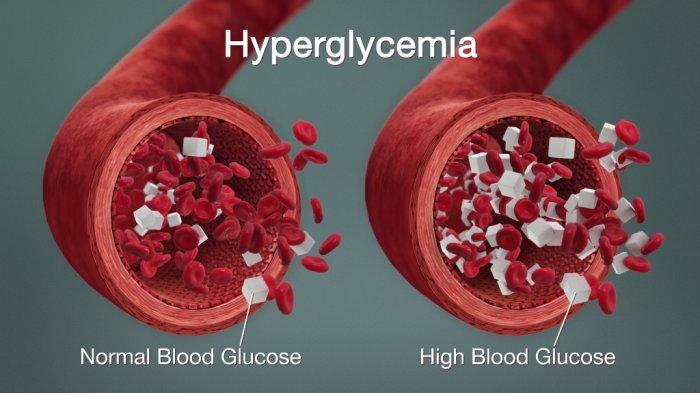 Mengenal Hiperglikemia Diabetes : Gejala, Penyabab dan Cara ...
