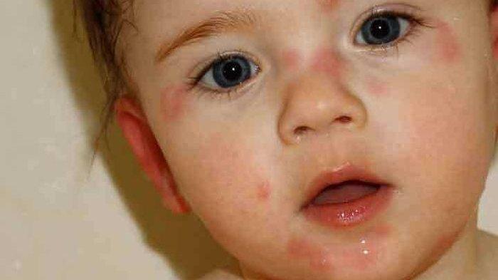 10 Pencegahan Penyakit Kulit Eksim yang Ditandai Bercak Merah dan Gatal ...