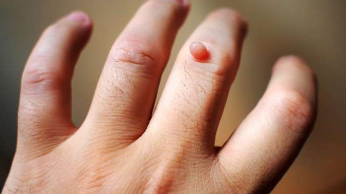 Alasan Utama Kenapa Jangan Pernah Coba-coba Potong Kutil Sendirian ...