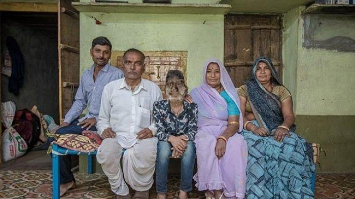 Kisah Lalit Patidar Bocah Asal India, Tubuh dan Wajahnya Ditutupi ...