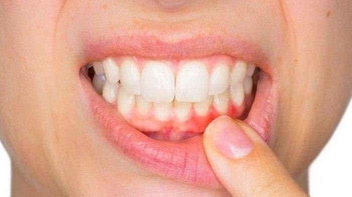 Ini Cara Mengobati dan Mencegah Sariawan - Tribunjogja.com