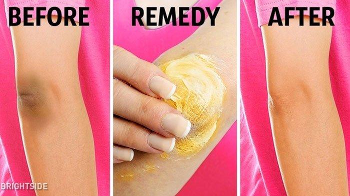 10 Tips Atasi Lutut dan Siku Hitam, Cuma Pakai Bahan Alami dan ...