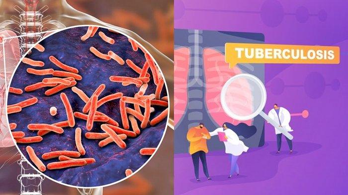 Upaya Pencegahan Tuberkulosis di Balikpapan, DKK Gencar Memberikan ...