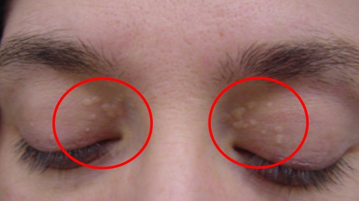 Waspada Jika Muncul Bercak Putih di Sekitar Kelopak Mata, Kadar ...