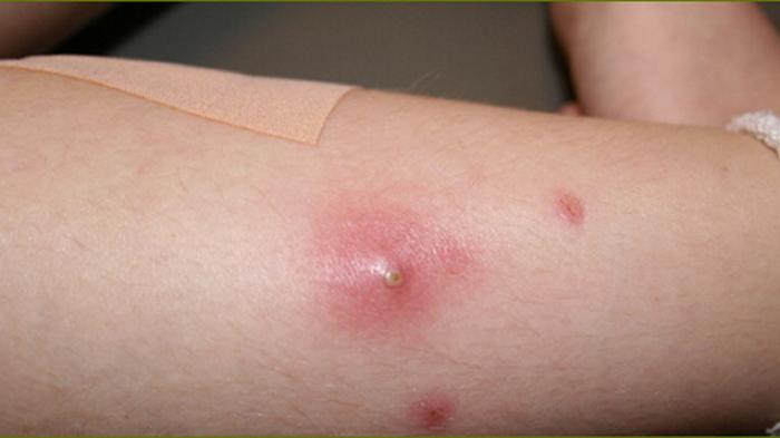 Sebelum Bisul Membesar dan Parah, Obati dengan Cara Alami Ini ...