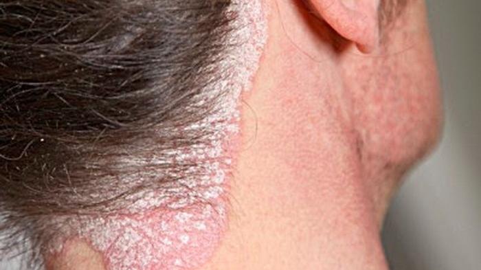 3 Ramuan Tradisional Ini Ampuh Mengobati Kadas dan Kurap - Tribunkaltim.co