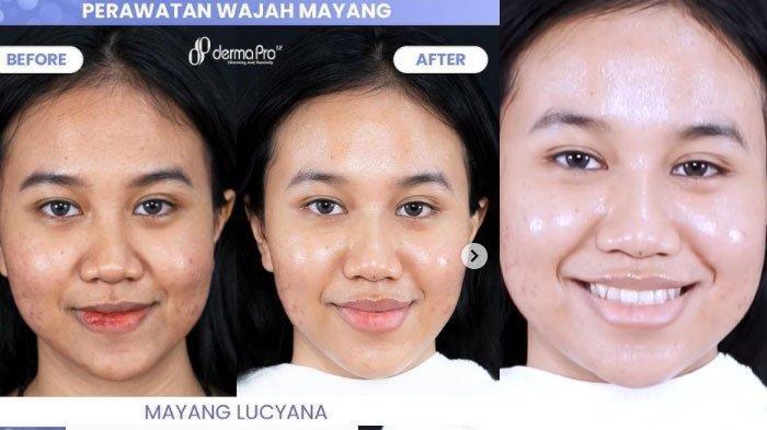 Mayang Lakukan Perawatan Wajah Rp 50 Juta, Perbedaan Penampilan Baru ...