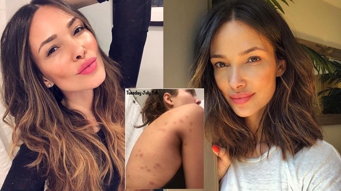 Digigit Kutu Kasur saat Menginap, Sabrina Jales Model Victoria's Secret ...