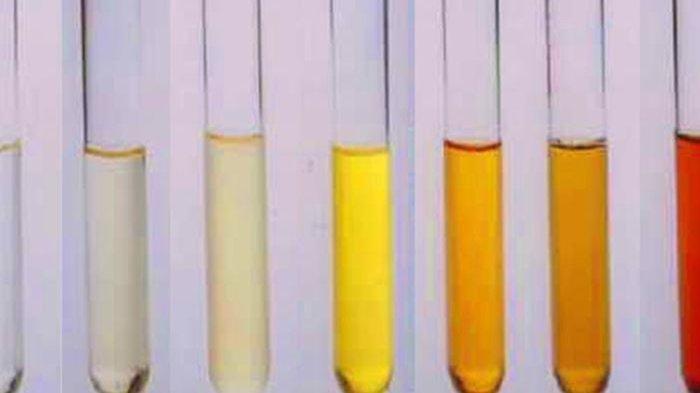 6 Jenis Warna Urine dan Penjelasan Lengkapnya, Kuning Gelap Pertanda ...