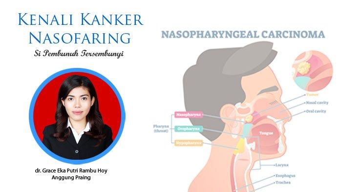 Kenali Kanker Nasofaring, Si Pembunuh Tersembunyi - Pos-kupang.com