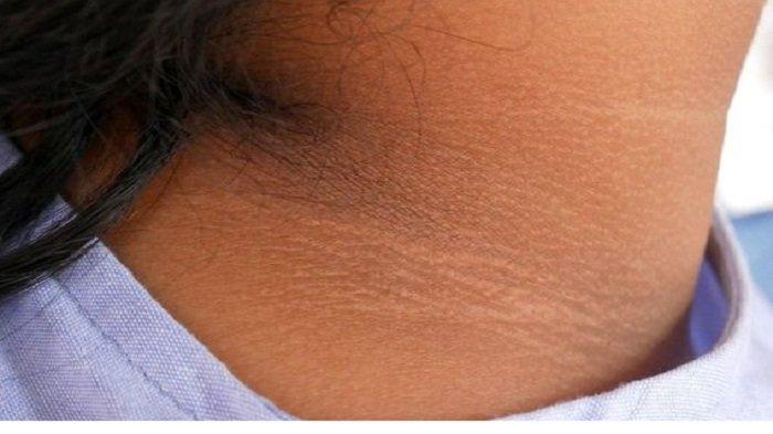 Apa itu Daki dan Bagaimana Menghilangkan Daki Badan? Gunakan Bahan ...