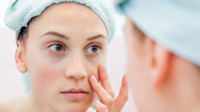 Kenali Gejala Penyakit Lupus atau Autoimun Kronis, Ruam Wajah Hingga ...