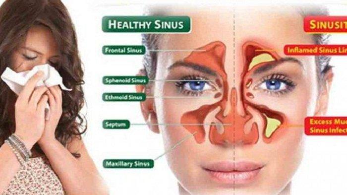 Batuk hingga Demam, Kenali Penyebab, Gejala Penyakit Sinusitis - Pos ...