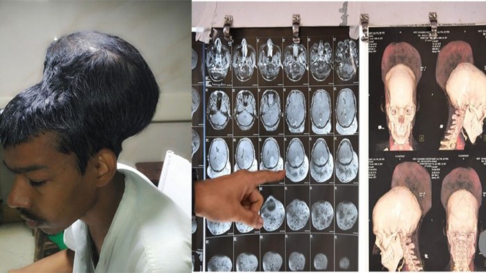 Dokter Berhasil Mengangkat Tumor Otak Seberat 4 Kg di Kepala Pria Ini, Diduga Terbesar di Dunia ...