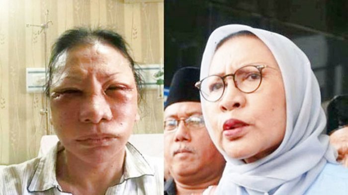 Penjelasan Medis Kenapa Wajah Ratna Sarumpaet Lebam Usai Operasi Sedot ...