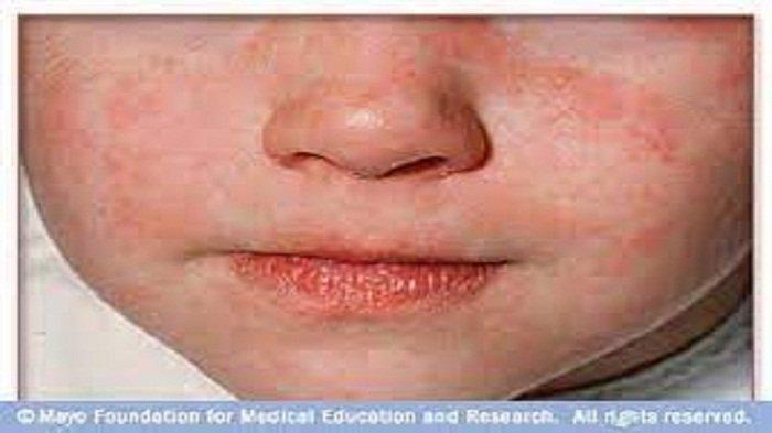 Rubella Bisa Menular pada Anak melalui Percikan Liur, Gejala ...