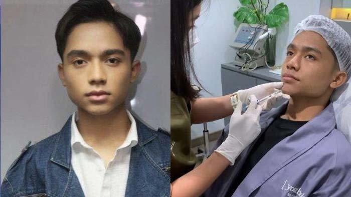 Betrand Peto Jalani Filler Dagu untuk Tampil Maskulin - Tribunlampung.co.id