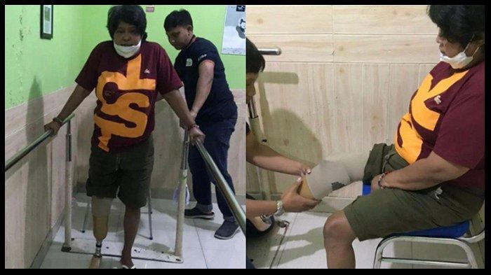 Kakinya Diamputasi, Suti Karno Kini Menggunakan Kaki Palsu ...
