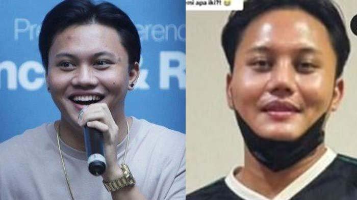 Perubahan Wajah Rizky Febian Usai Operasi Plastik Hidung Jadi Sorotan ...