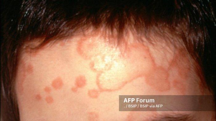 Halo Dokter, Apa Itu Penyakit Kurap dan Apa yang Jadi Penyebabnya ...