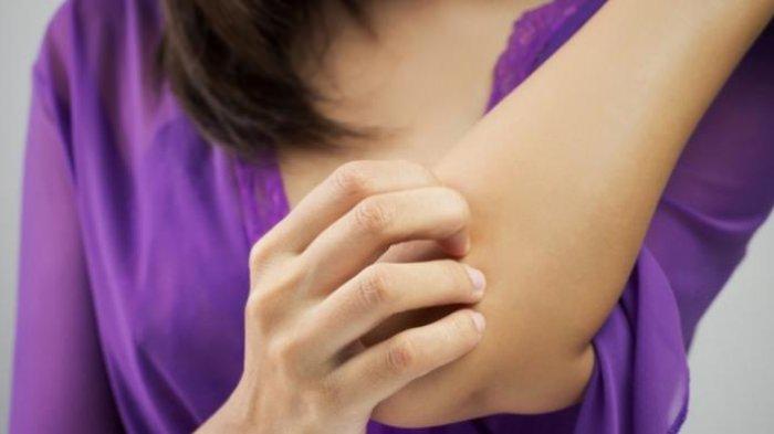Dermatitis Adalah Penyakit Peradangan Kulit - Kenali Gejala, Penyebab ...