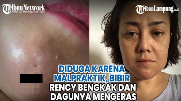 VIDEO Rency Milano Diduga Korban Malapraktik Filler, Bibir Bengkak dan ...