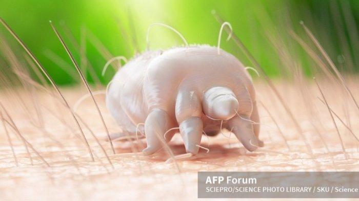 Halo Dokter, Apa Itu Kudis dan Gejalanya Seperti Apa - Tribunlampung.co.id