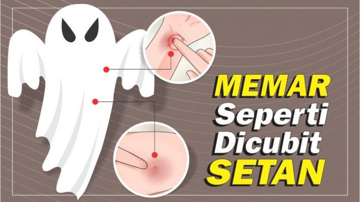 GRAFIS: Benarkah Timbul Memar di Badan Akibat Dicubit Setan? Ini ...