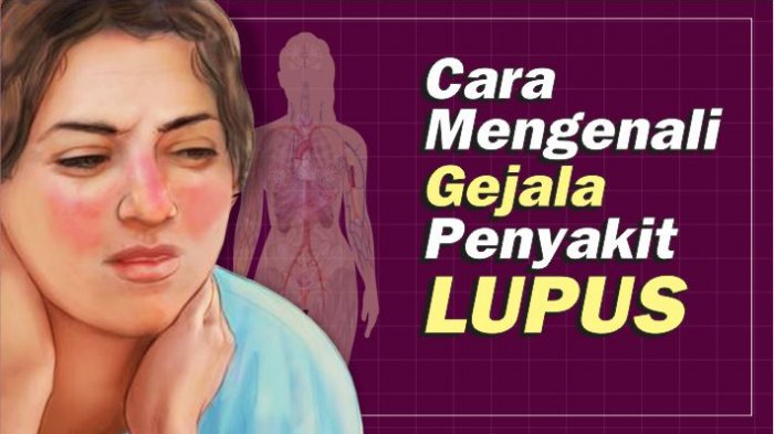 GRAFIS: Gejala Penyakit Lupus yang Perlu Kita Ketahui - Tribunlampung.co.id