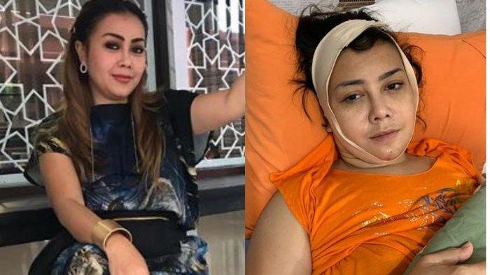 Ingin Percantik Bibir, Artis Rency Milano Malah Alami Bengkak di Bibir ...