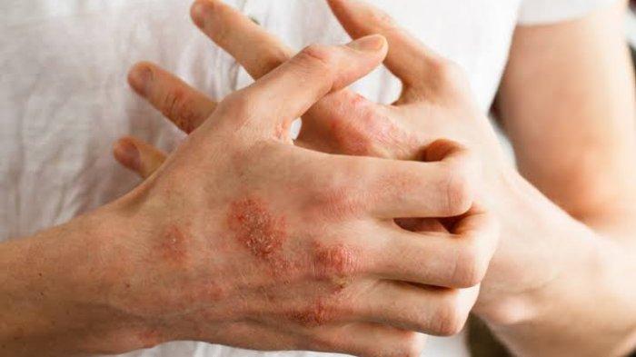 Mengenal Apa Itu Penyakit Kusta dari Penjelasan Dokter Spesialis Kulit ...