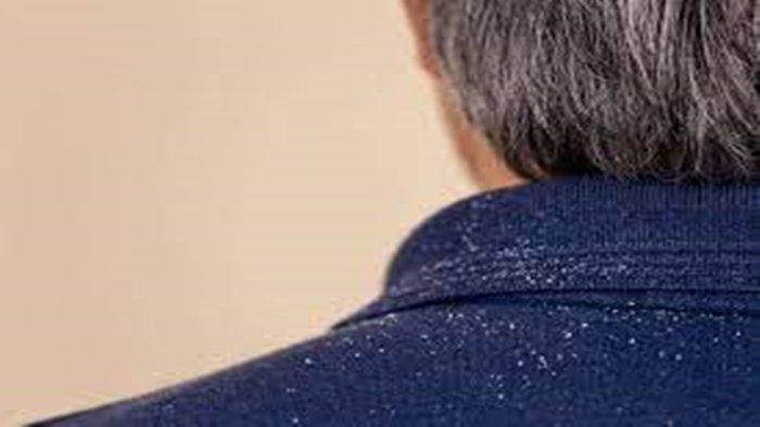 Apa Itu Ketombe? Ini Penyebab, hingga Cara Mengobati - Tribunlombok.com