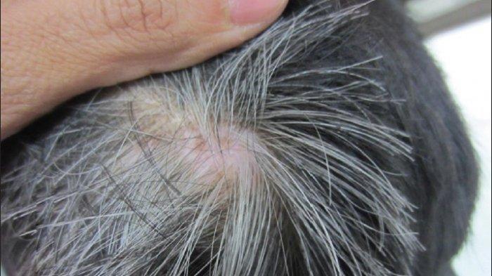 Rambut Muncul Uban di Usia Muda, Ternyata Ini Lima Penyebabnya - Tribunlombok.com